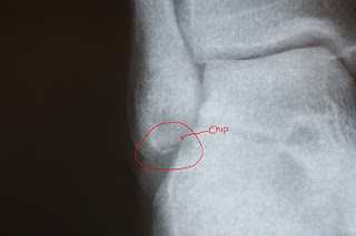 Clean Up Set: Bone chip.........Ouch!