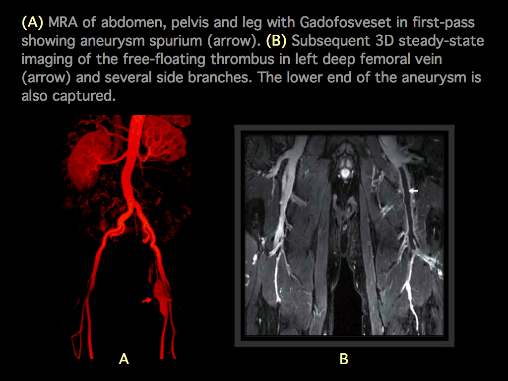MRI BLOG: New Blood Pool Contrast Agent - Ablavar