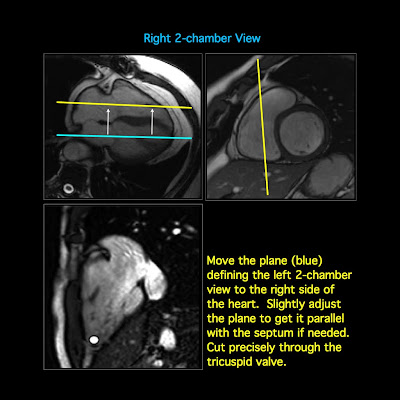 MRI BLOG: Cardiac MRI - Imaging Planes for Basic Cardiac Views