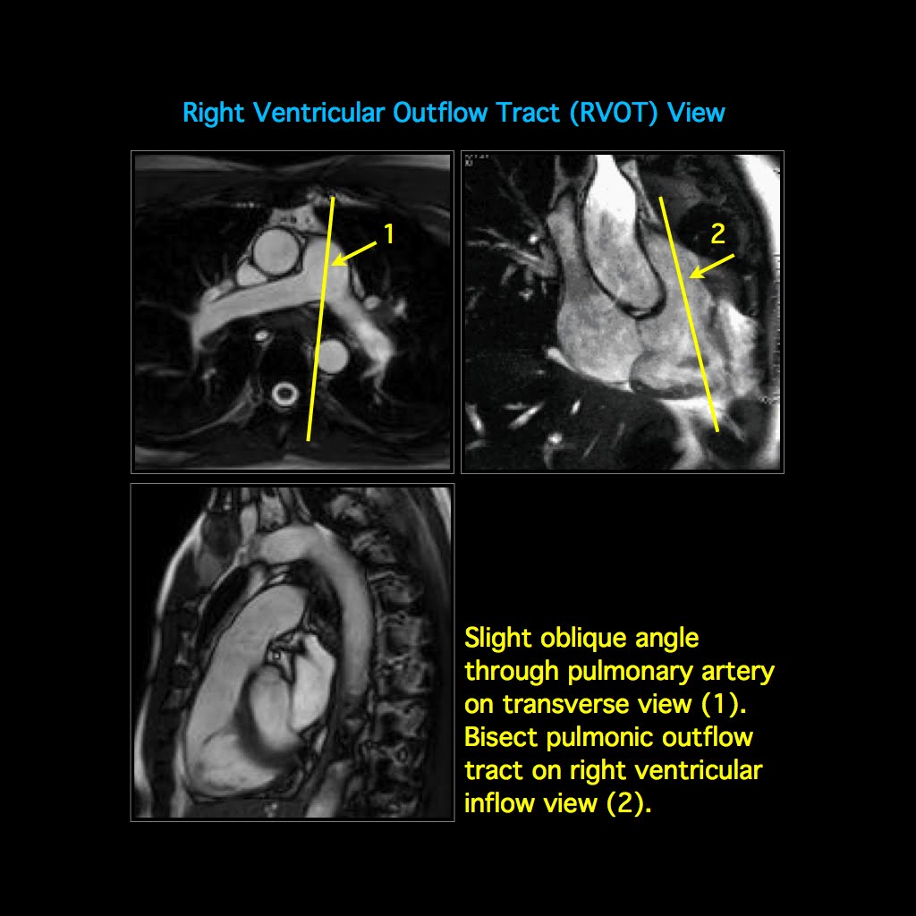 MRI BLOG: Cardiac MRI - Imaging Planes for Basic Cardiac Views