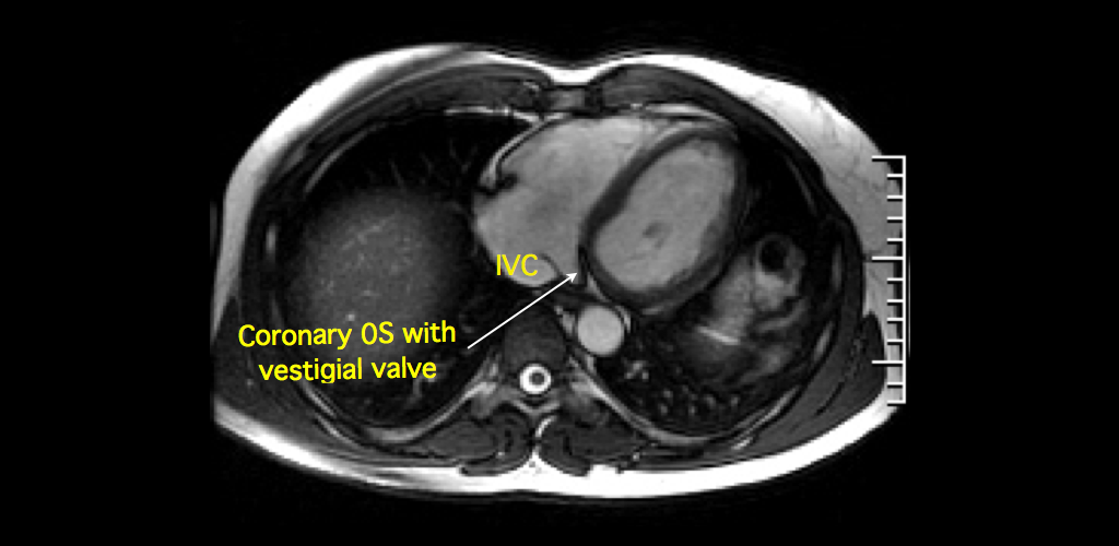 MRI BLOG: Cardiac Anatomy