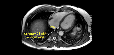 MRI BLOG: Cardiac Anatomy