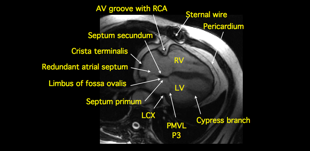 MRI BLOG: Cardiac Anatomy