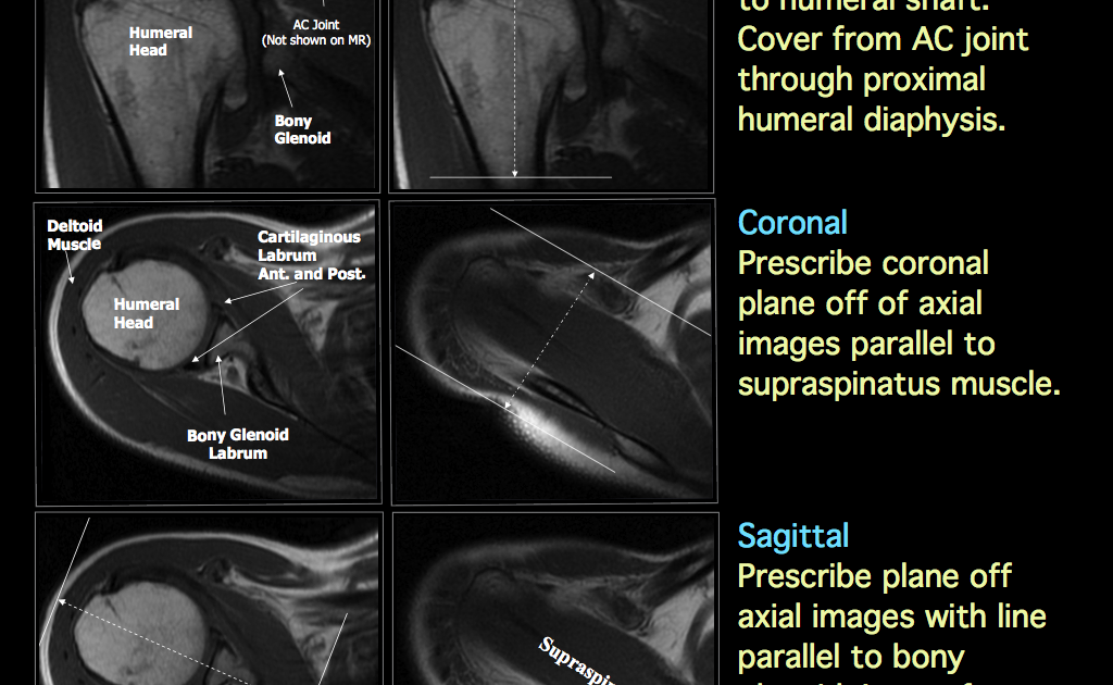 MRI BLOG: Shoulder MRI