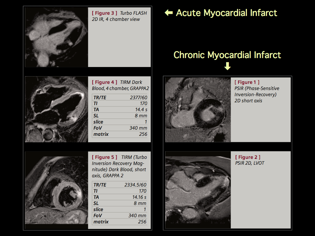 MRI BLOG: Imagery of Cardiac Pathology