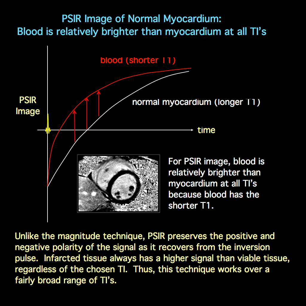 MRI BLOG: Phase Sensitive Inversion Recovery