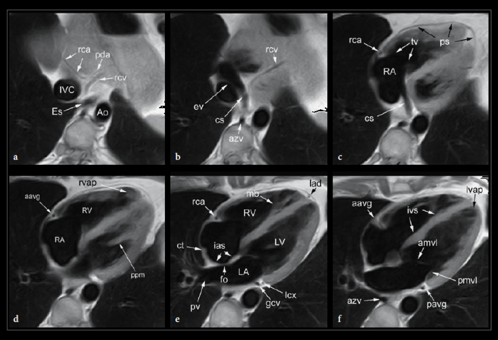 MRI BLOG: Detailed CMR Anatomy