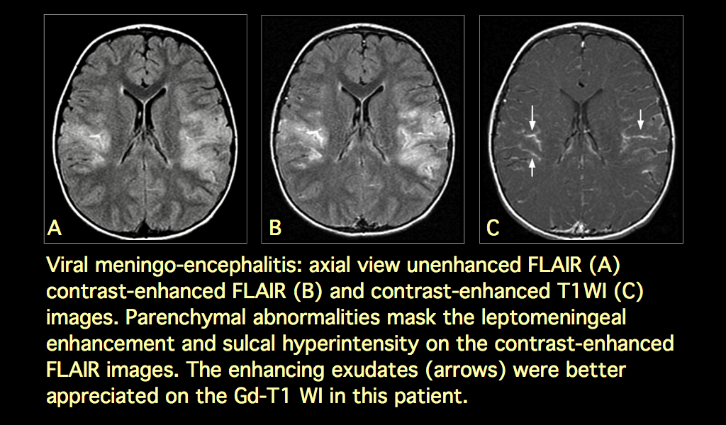 MRI BLOG: Contrast-enhanced FLAIR for Infectious Leptomeningitis