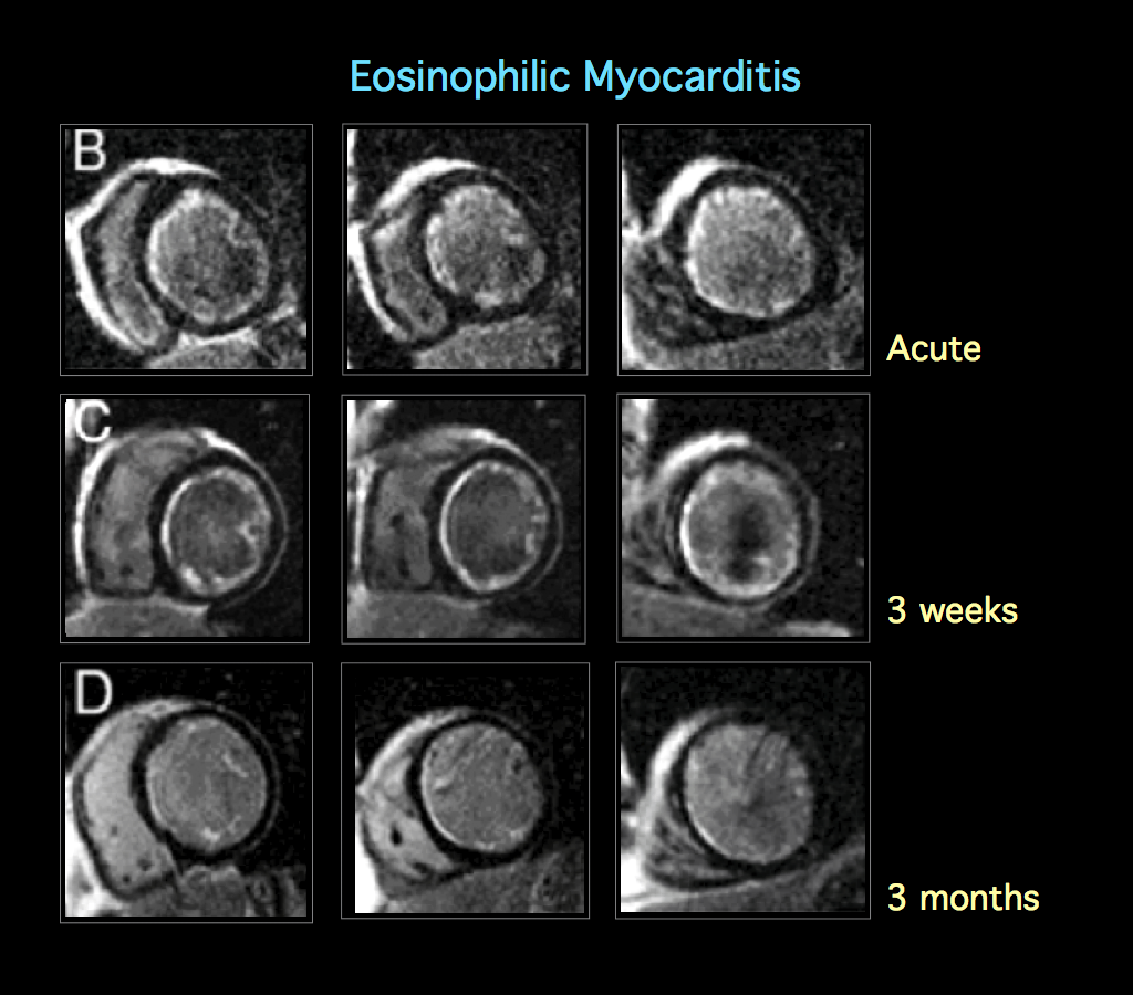 MRI BLOG: Imagery of Cardiac Pathology