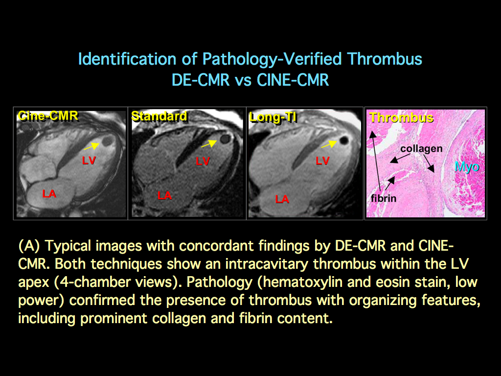 MRI BLOG: CMR Imaging of Thrombus