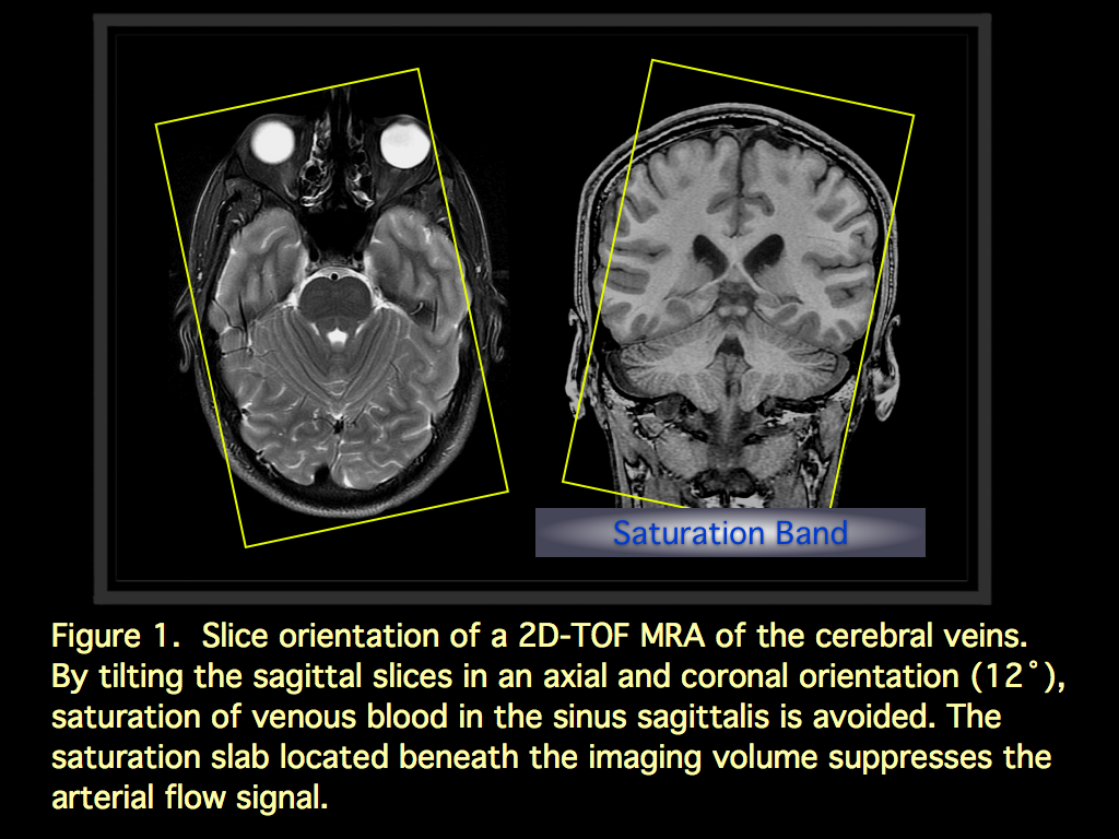 MRI BLOG: Dural Sinus Thrombosis