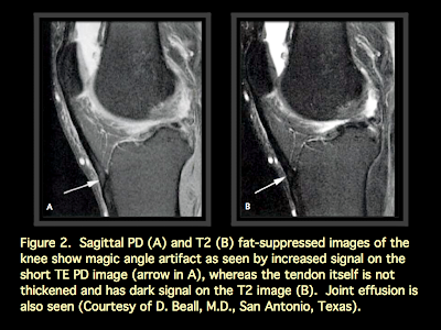 MRI BLOG: Magic Angle Phenomenon