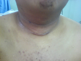 PACES MRCP UK - Where MRCPians Meet Since 2006: A Neck Scar In Abdomen ...