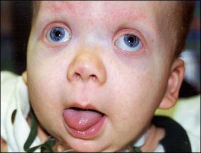 Doctors Gates: Beckwith-Wiedemann Syndrome (BWS)