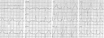 Doctors Gates: ECG changes in Hyperkalemia