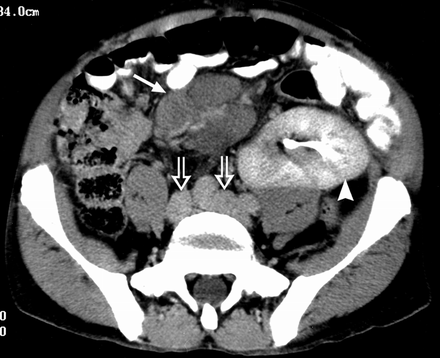 ON - RADIOLOGY: The Sandwich Sign