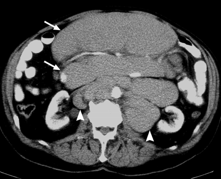 ON - RADIOLOGY: The Sandwich Sign