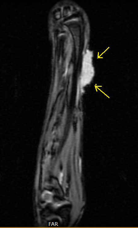 ON - RADIOLOGY: Marjolin Ulcer-MRI