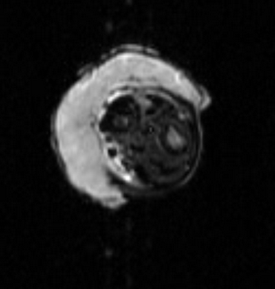 ON - RADIOLOGY: Marjolin Ulcer-MRI