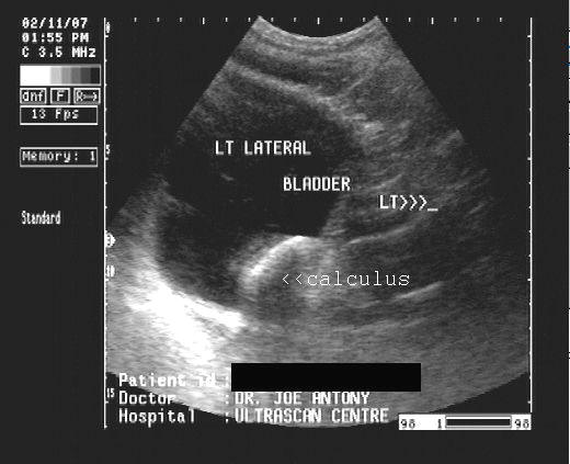 ON - RADIOLOGY: Large urinary bladder calculus (by Pie Scanner 100 ...