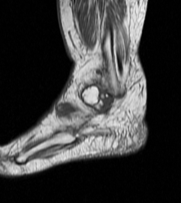 ON - RADIOLOGY: Lipoma arborescens of Ankle MRI (what`s that !!!)
