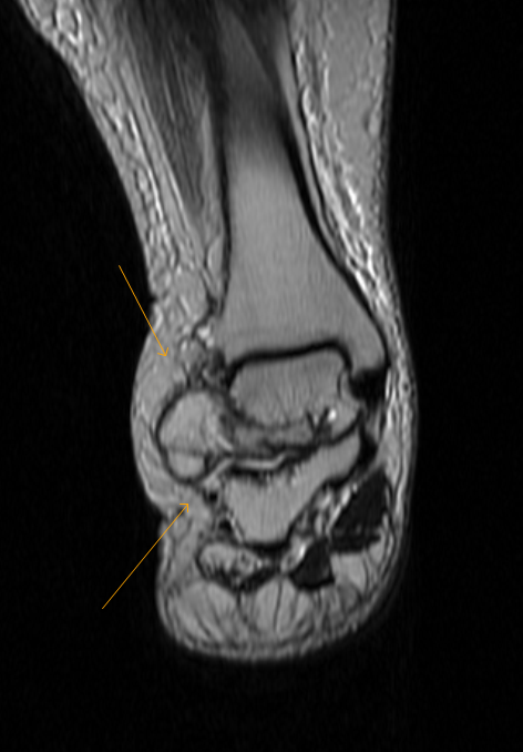 ON - RADIOLOGY: Lipoma arborescens of Ankle MRI (what`s that !!!)