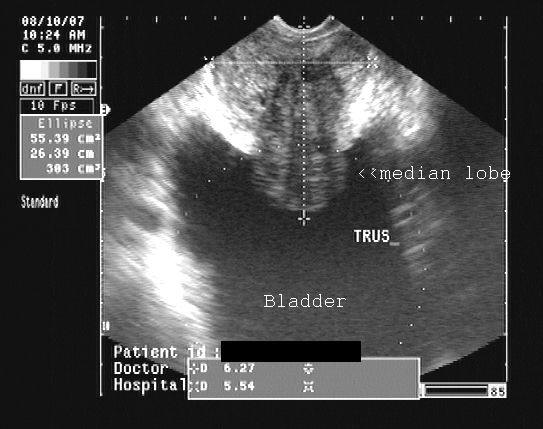 ON - RADIOLOGY: Ultrasound images of Benign prostatic hyperplasia