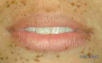 DOCTORS GATE.: Ephelides (freckles)