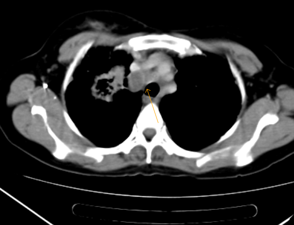 ON - RADIOLOGY: Liver tuberculoma on CT