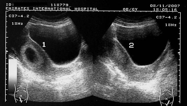 ON - RADIOLOGY: Ultrasound images of Bicornuate uterus with gestation sac