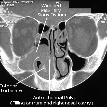 Doctors Gates: Antrochoanal Polyp