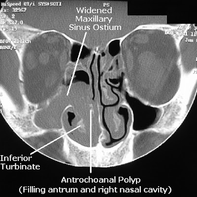 Doctors Gates: Antrochoanal Polyp