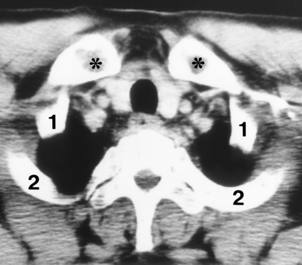 ON - RADIOLOGY: Counting Ribs in CT Scan by Clavicle