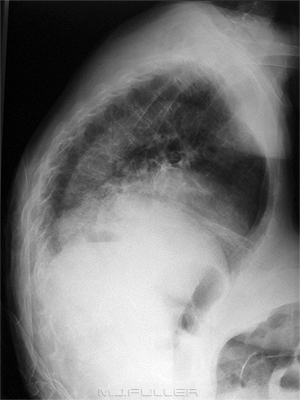 ON - RADIOLOGY: Chest X-rays of the Kyphotic Patient