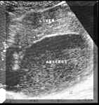 Doctors Gates: Ultrasound of Amoebic Liver Abscess
