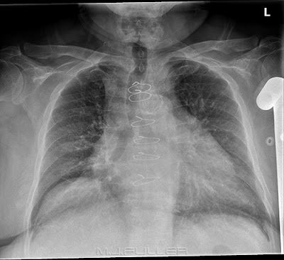 ON - RADIOLOGY: Chest Radiography for a Wheelchair-bound Patient