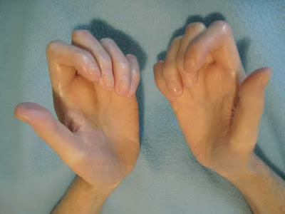 Doctors Gates: Sclerodactyly in Systemic Scleroderma