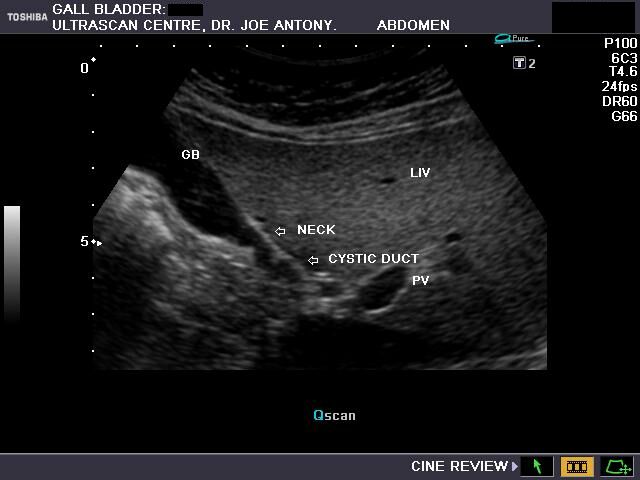 ON - RADIOLOGY: Normal Anatomy of Gall bladder