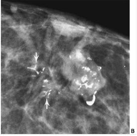 ON - RADIOLOGY: CALCIFICATIONS in Carcinoma of the breast