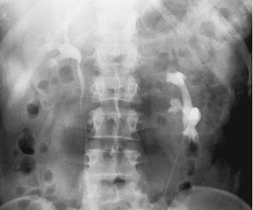 ON - RADIOLOGY: Malrotation of the kidney