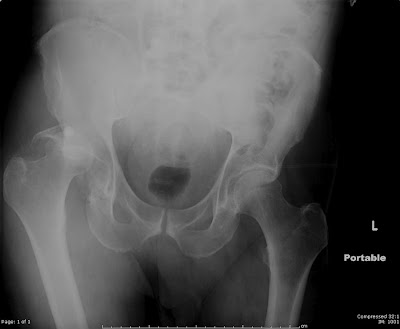 ON - RADIOLOGY: Central dislocation of Hip joint