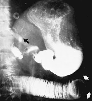 ON - RADIOLOGY: X-ray of Gallstone ileus