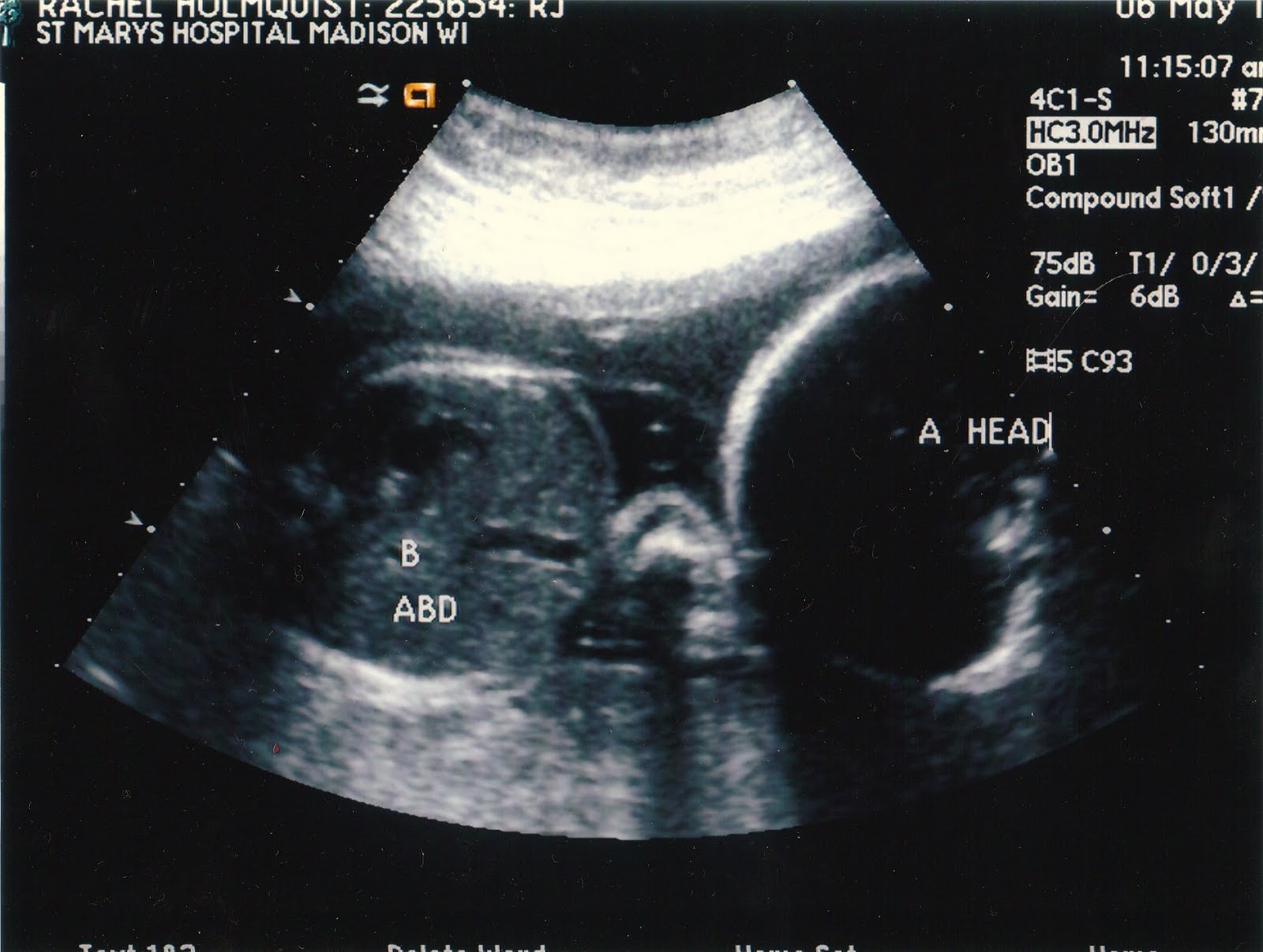 Gilberquist Family: 26 week ultrasound pictures