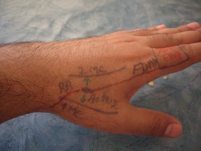 Dr.Fawaz AlBalushi / Plastic & Micro Reconstructive Surgery: Kite Flap