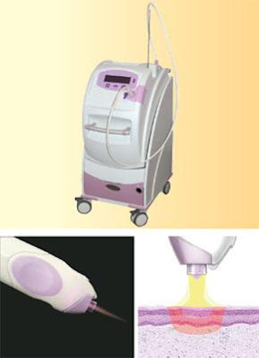 Anti Aging Treatments: Portrait® Plasma Skin Regeneration