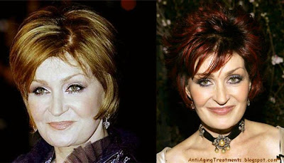 Anti Aging Treatments: Sharon Osbourne Plastic surgery