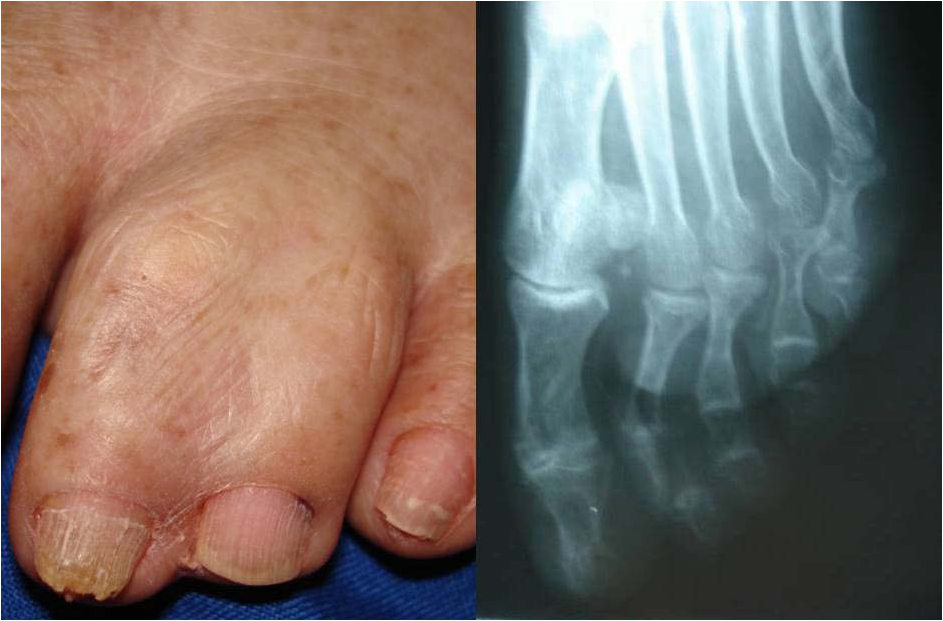 PODOLOGIA: LOS PIES SOBRE LA TIERRA #homeconsultingroom: SINDACTILIA