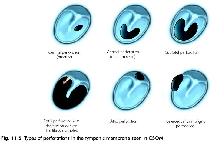 MEDICAL IMAGES: Types of perforation in CSOM