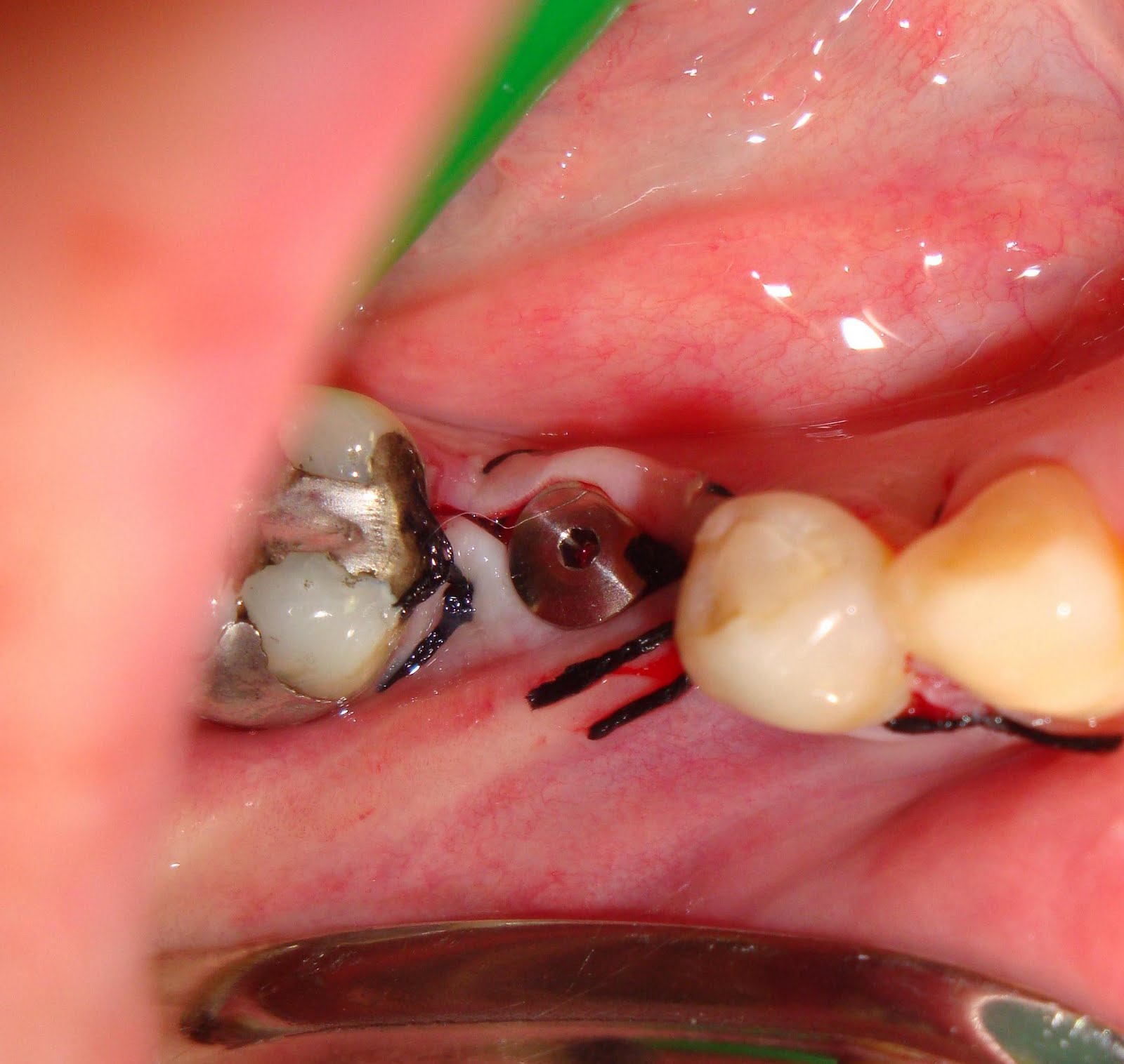 Implante Mathias: Estágio único com cicatrizadores switching