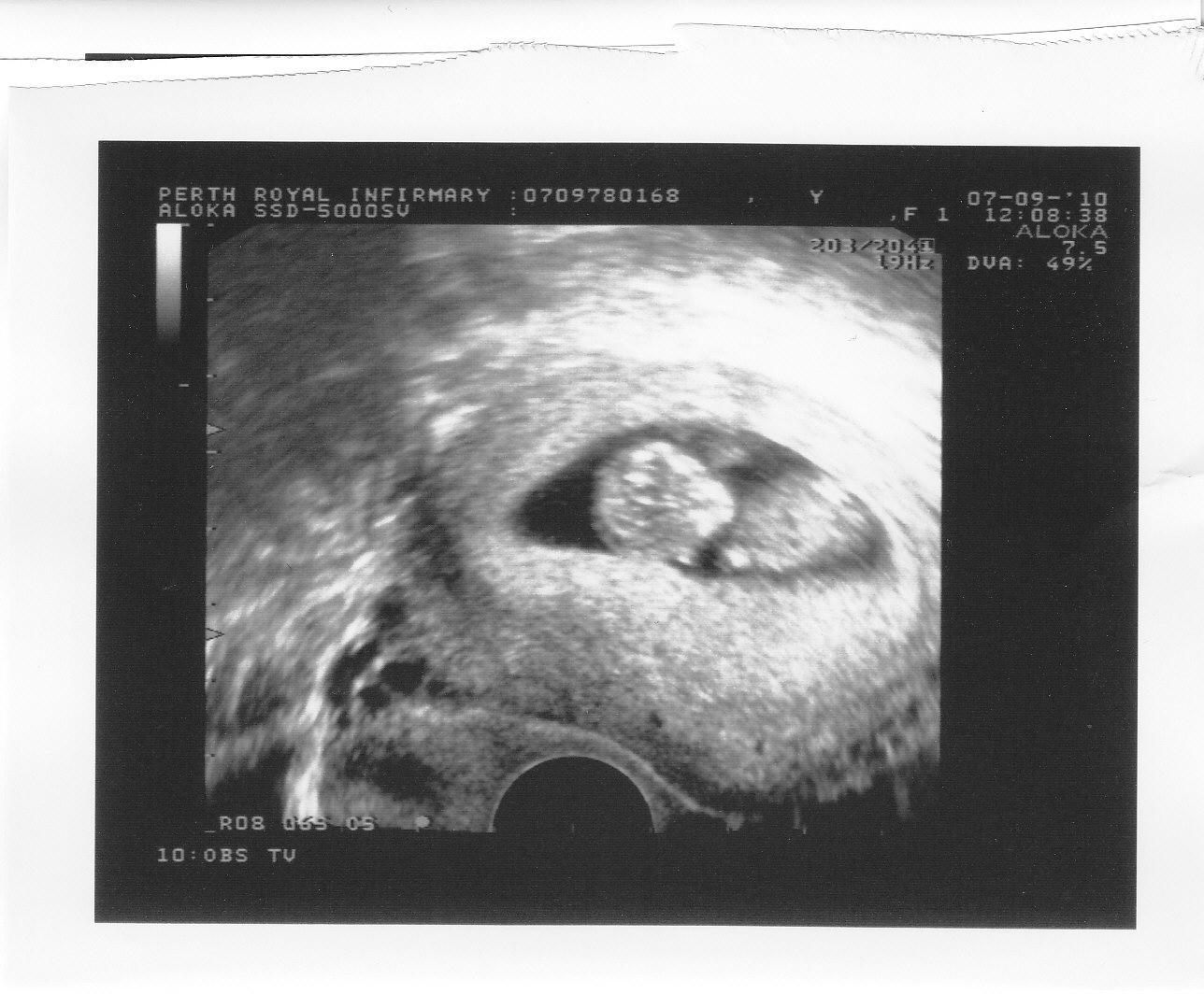 Our Wee Baby: babys first scan 10 weeks 5 days